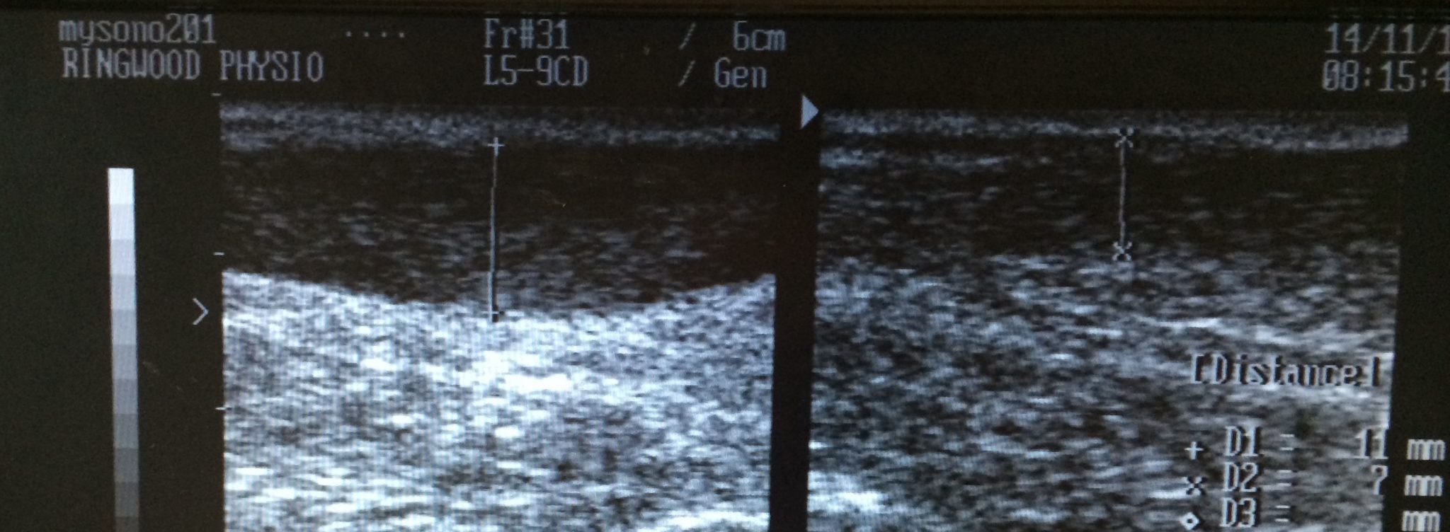 Pea Sized Lump On Achilles Tendon - Bump On Bottom Of Foot 9 Causes And ...