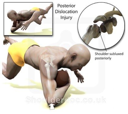 Anterior Shoulder Dislocation Mechanism Of Injury